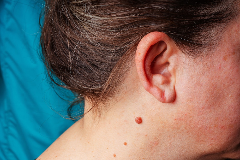 Buffalo Hump Removal: San Diego's Best Neck Fat Procedure | AirSculpt