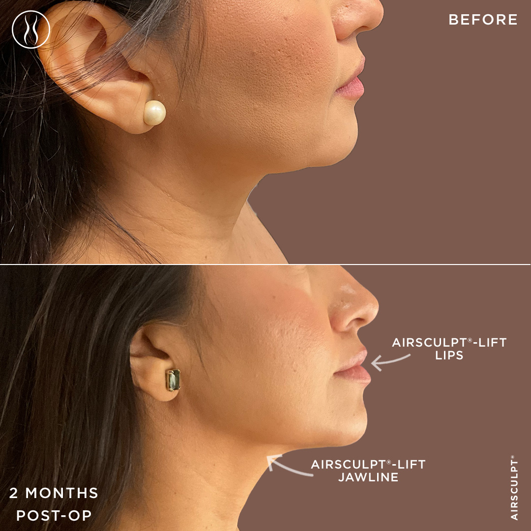 The Best Method For Naturally Restoring Lost Facial Volume | AirSculpt