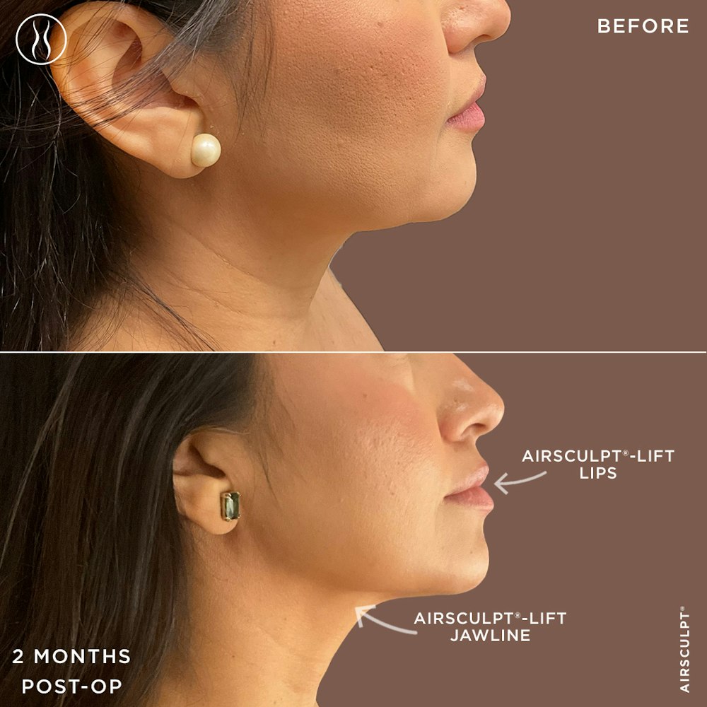 Fat Transfer for Ozempic Face: Natural Volume Restoration | AirSculpt