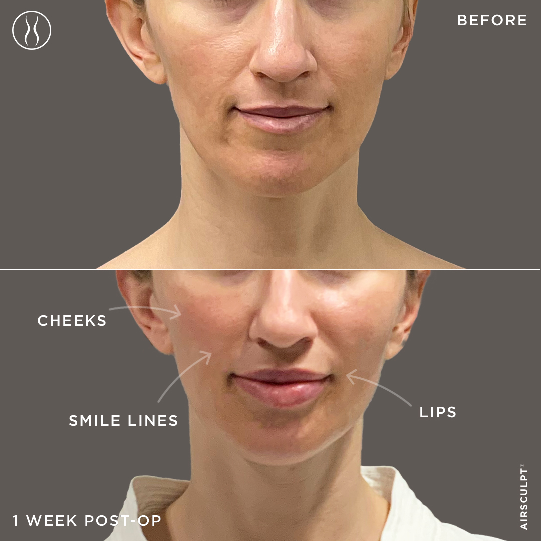 The Best Method For Naturally Restoring Lost Facial Volume | AirSculpt