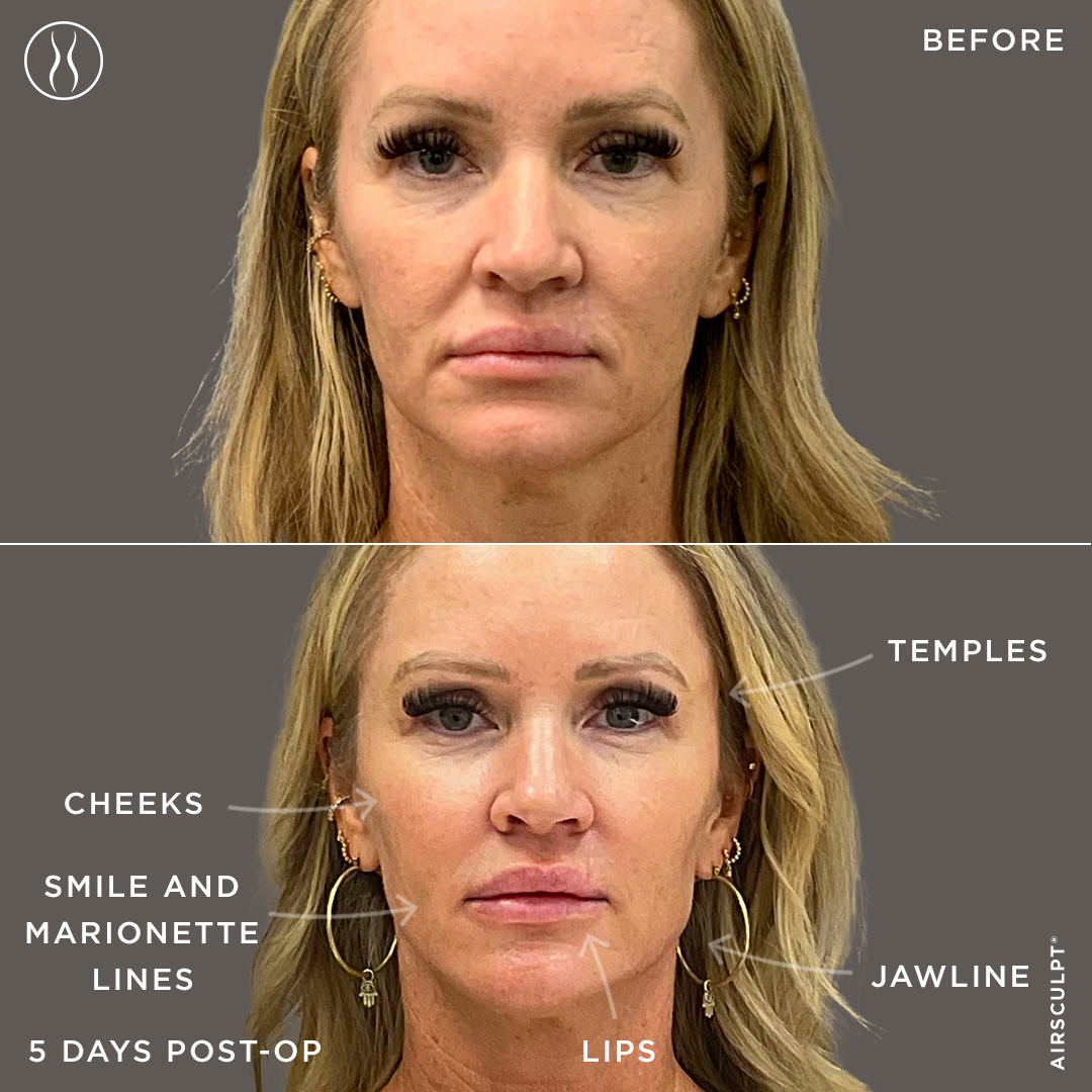 The Best Method For Naturally Restoring Lost Facial Volume | AirSculpt