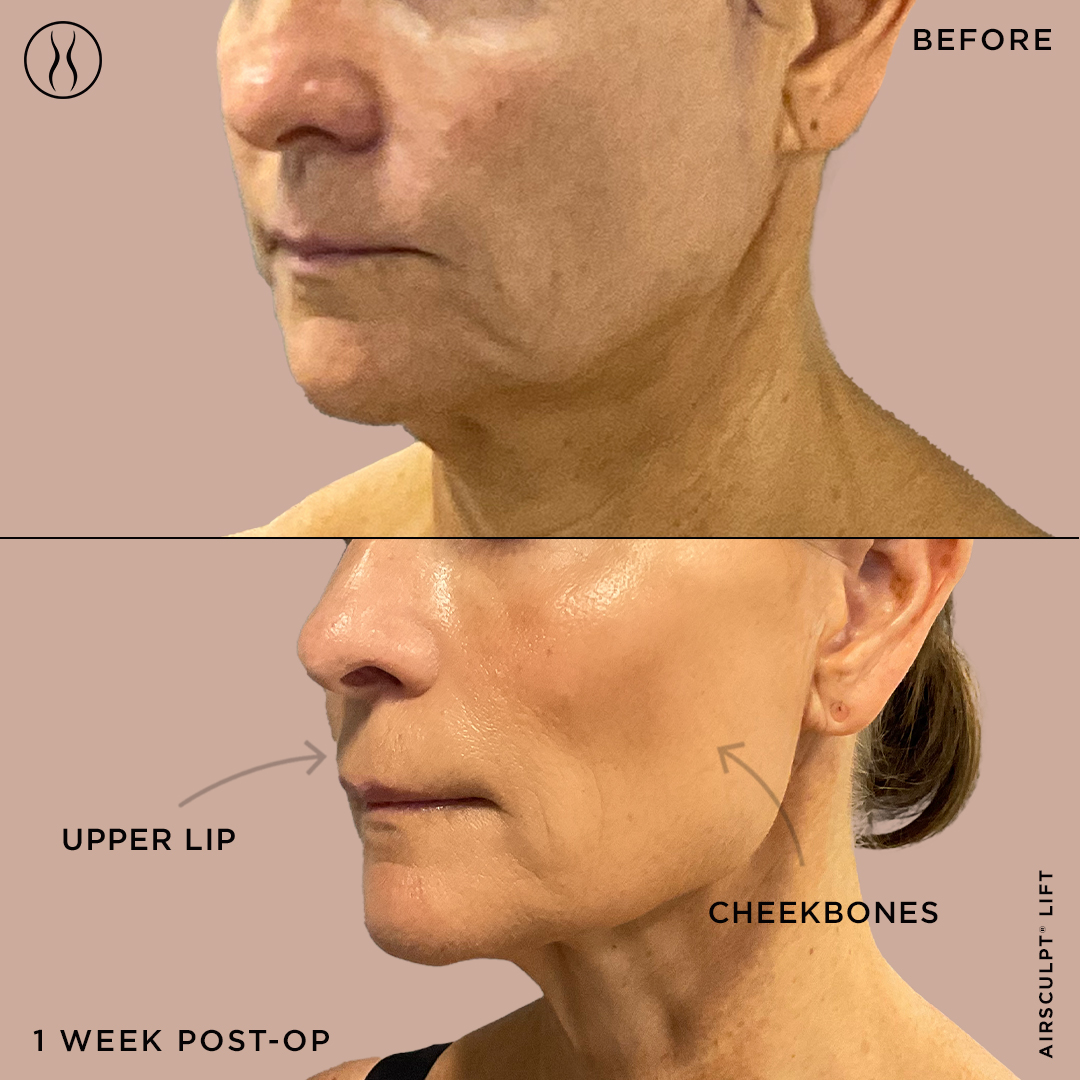 The Best Method For Naturally Restoring Lost Facial Volume | AirSculpt