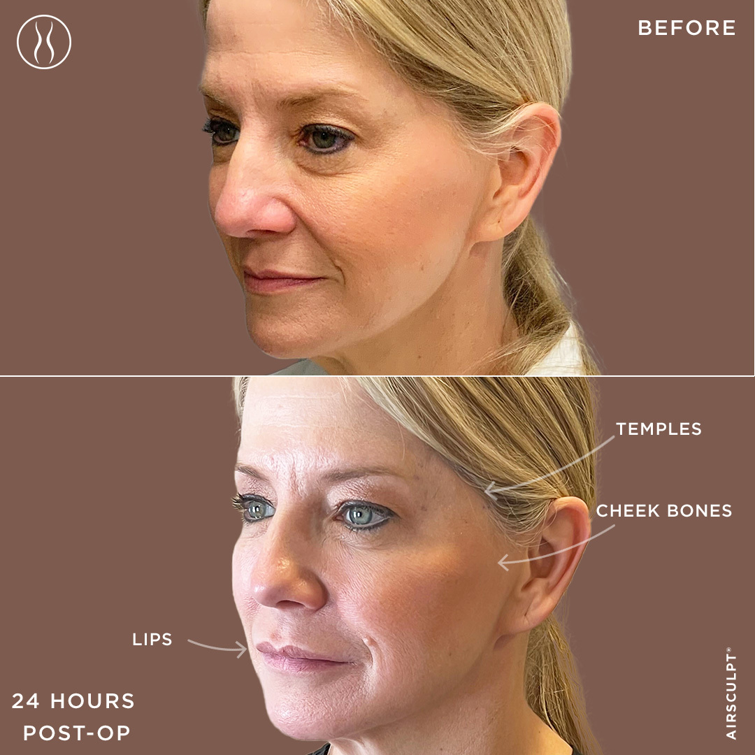 The Best Method For Naturally Restoring Lost Facial Volume | AirSculpt
