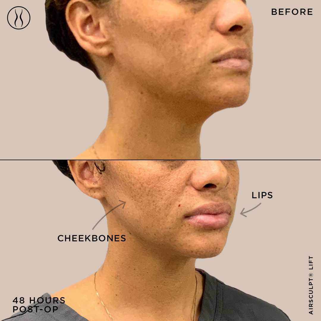 The Best Method For Naturally Restoring Lost Facial Volume | AirSculpt