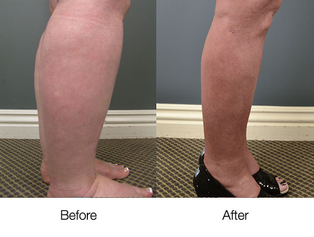 Lipedema Treatment Beverly Hills | Lipedema Surgery in Los Angeles