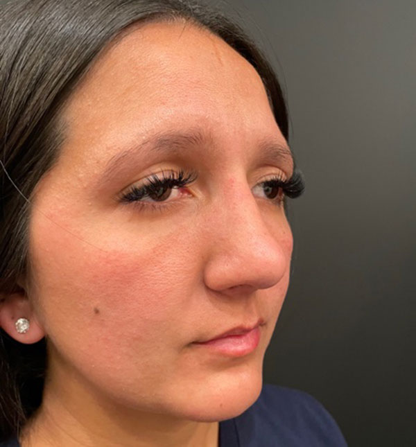 Chin Shaping | Dr. Remus Repta