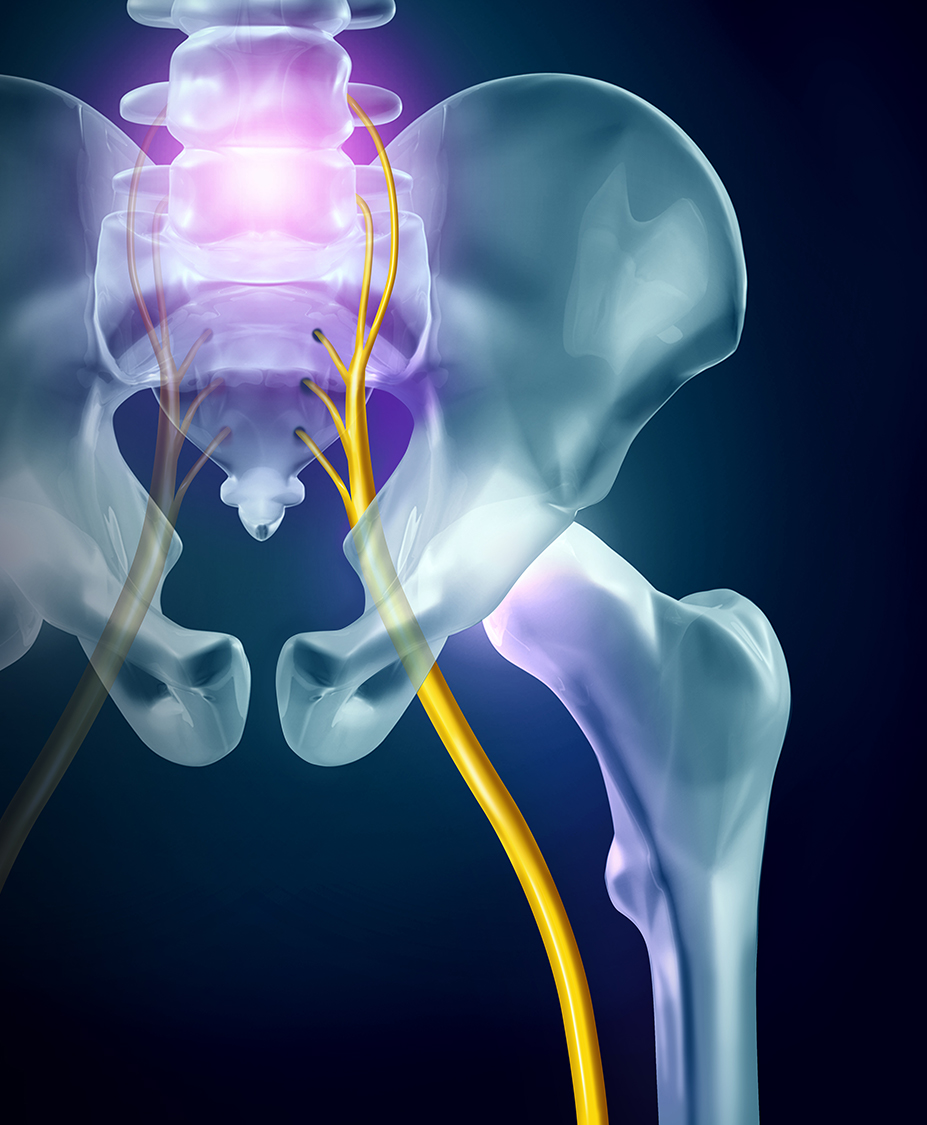 Sciatic Nerve Pain | Dr. Joshua Rovner