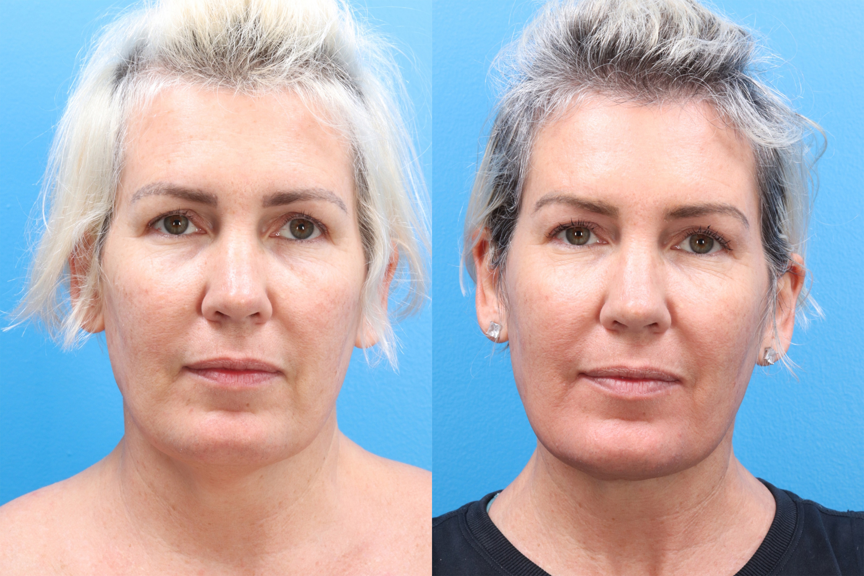 Ellevate Facial Rejuvenation | Sanctuary Plastic Surgery
