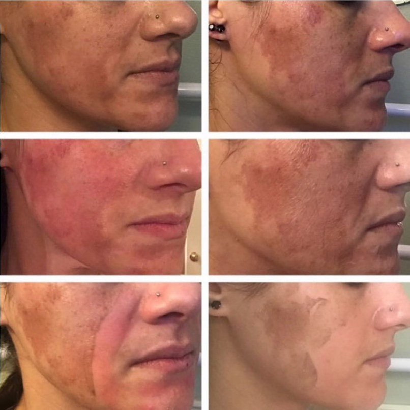 Skin Rejuvenation New York | Skin Rejuvenation Treatment NYC | Dr. Halaas