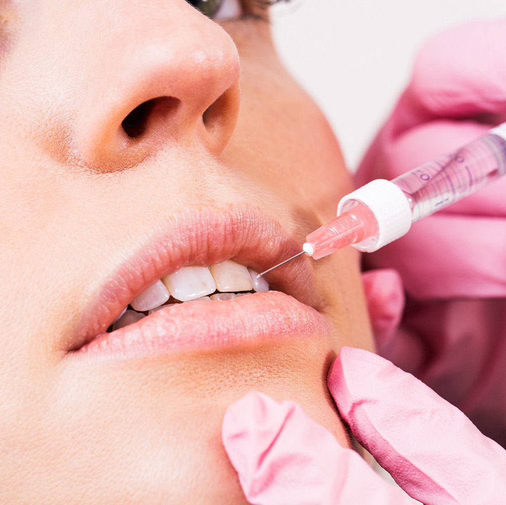 Lip Augmentation New York | Westchester Lip Augmentation Surgery