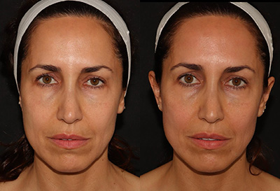 Long Face Syndrome Surgery Before And After