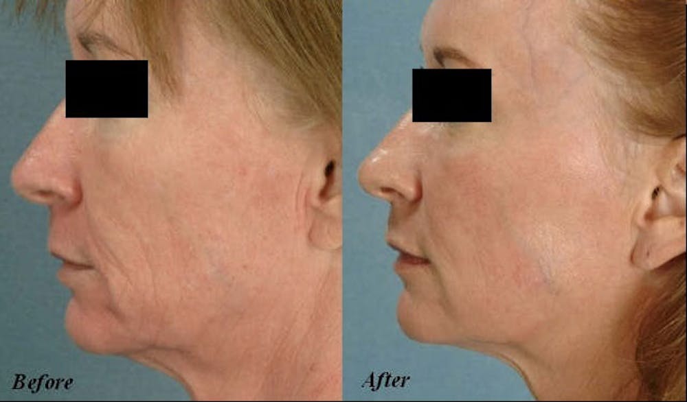 Patient 24560254 | Active FX Before & After Photos | Laser Cliniqúe