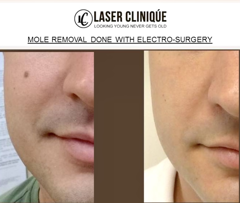 Mole Removal Before And After