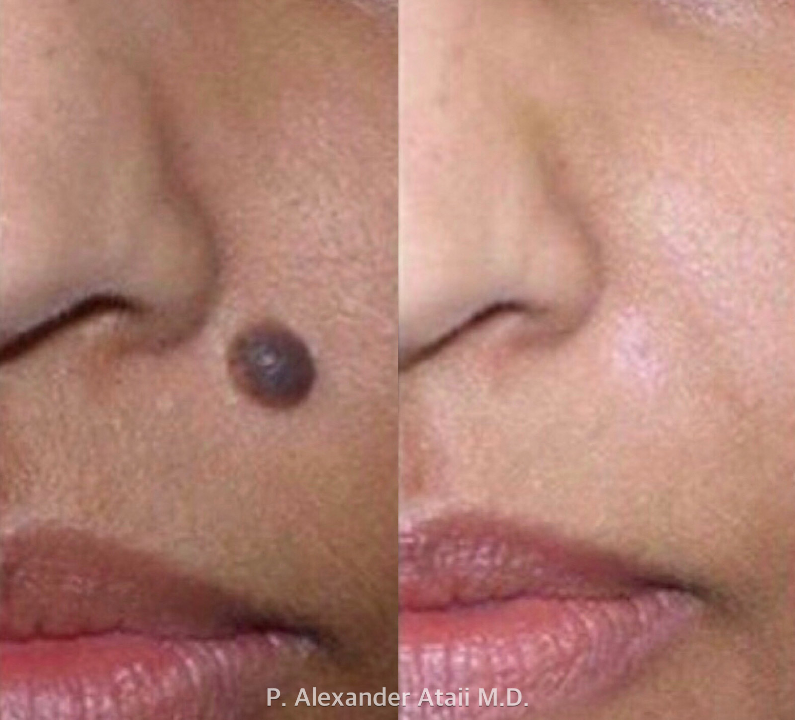 Mole Removal Before And After
