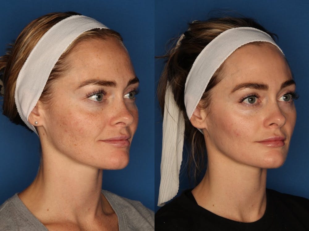 Patient 143416468 | BBL Hero Before & After Photos | Laser Cliniqúe