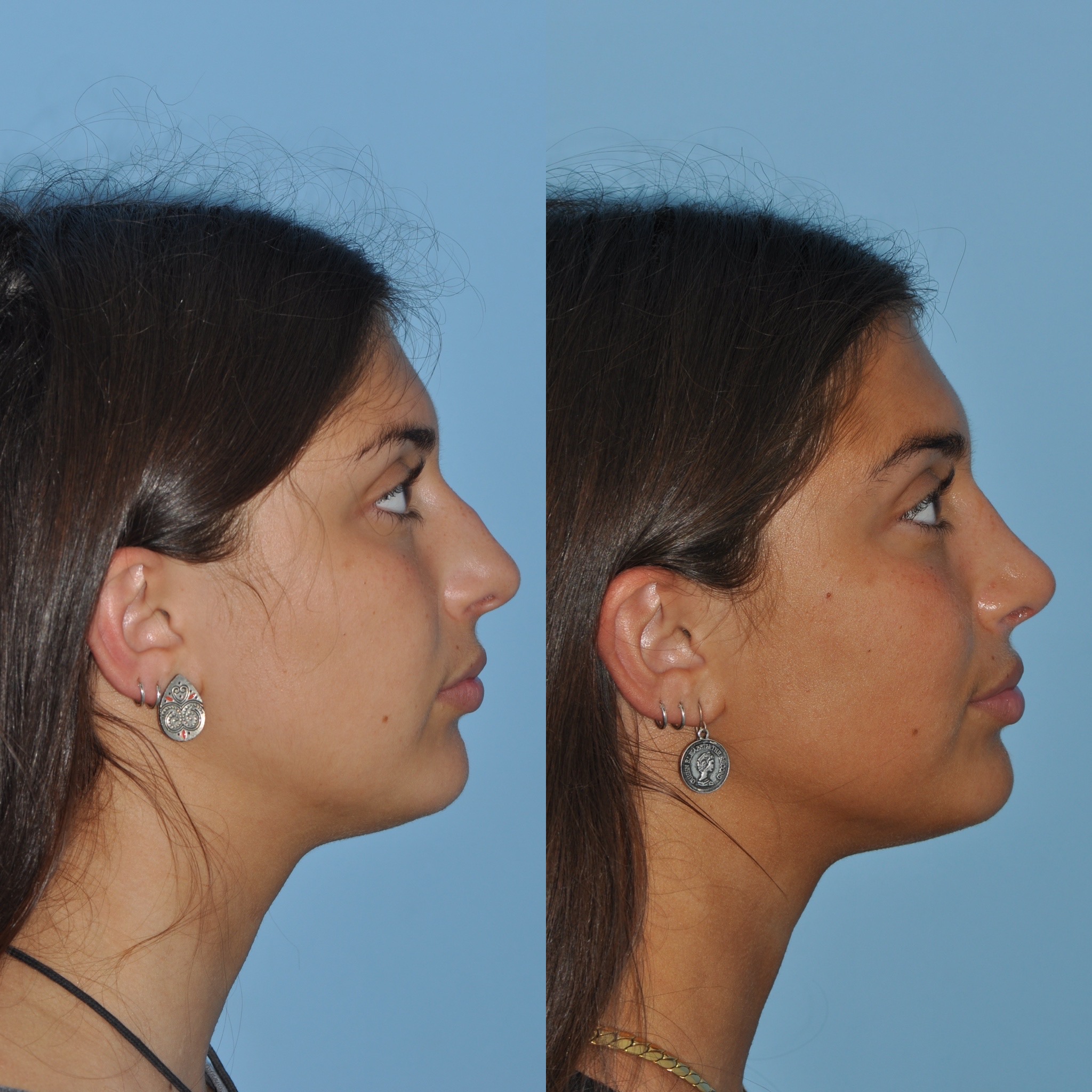 Nose Job Before And After Profile