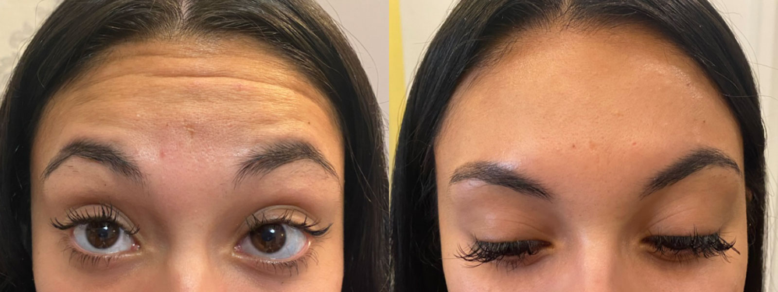 Botox in Philadelphia | Wrinkle Reduction in Bryn Mawr