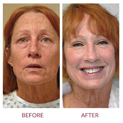Laser Skin Resurfacing Palm Springs CO2 Laser Face Resurfacing Rancho Laser Skin Resurfacing Palm Springs CO2 Laser Face Resurfacing Rancho