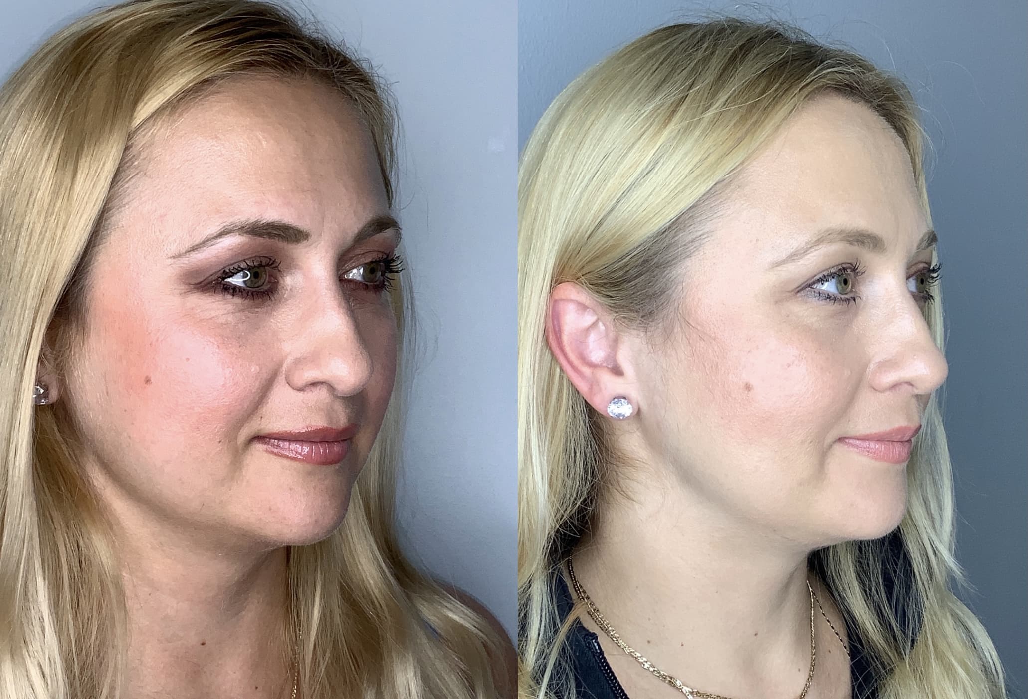 Buccal Fat Removal Before & After Photos | Arroyo Plastic Surgery