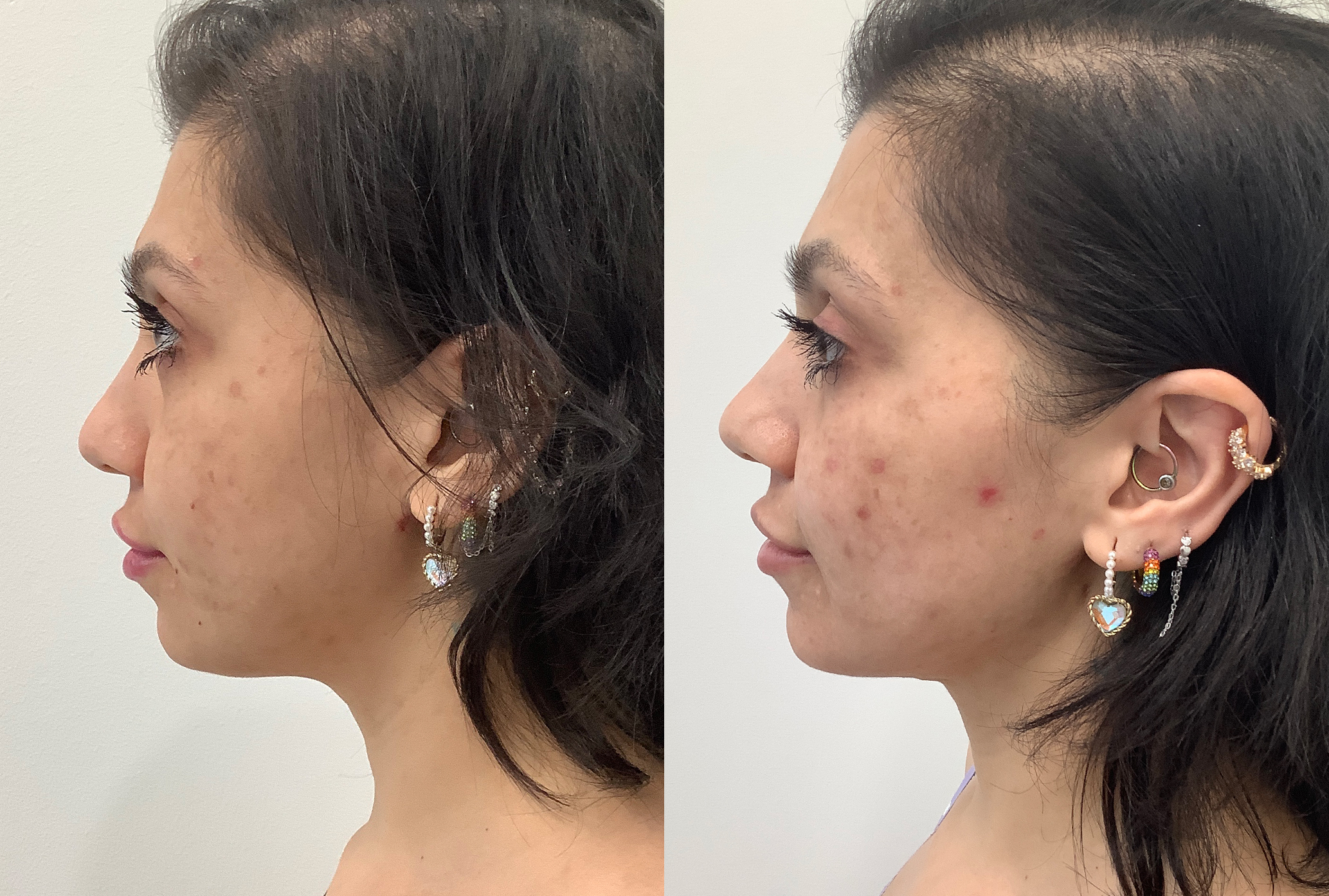 Neck Liposuction Before & After Photos | Arroyo Plastic Surgery