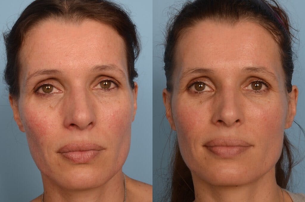 Radiesse Before & After Photos | Grossman Dermatology