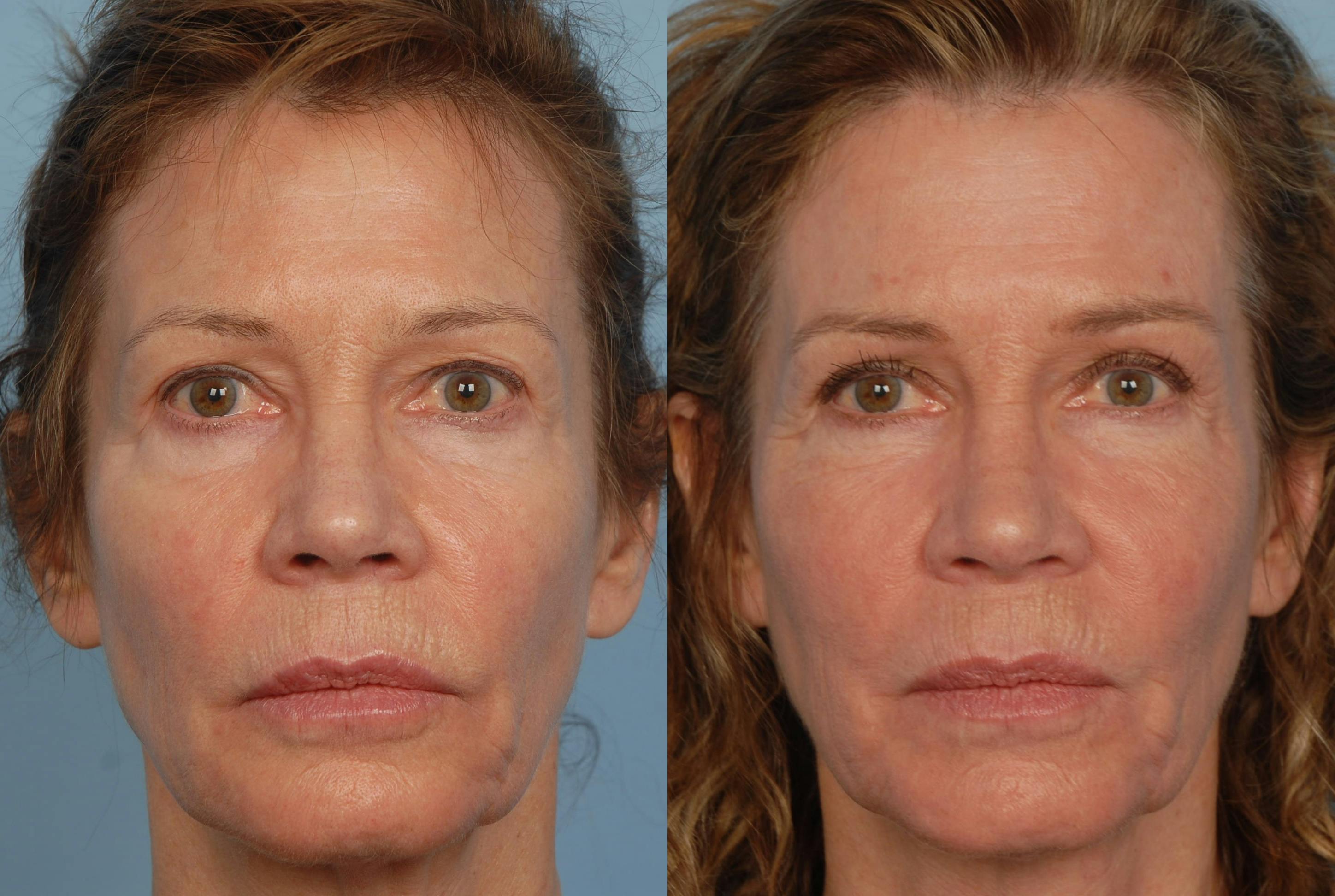 Fractionated CO2 Before & After Photos | Grossman Dermatology