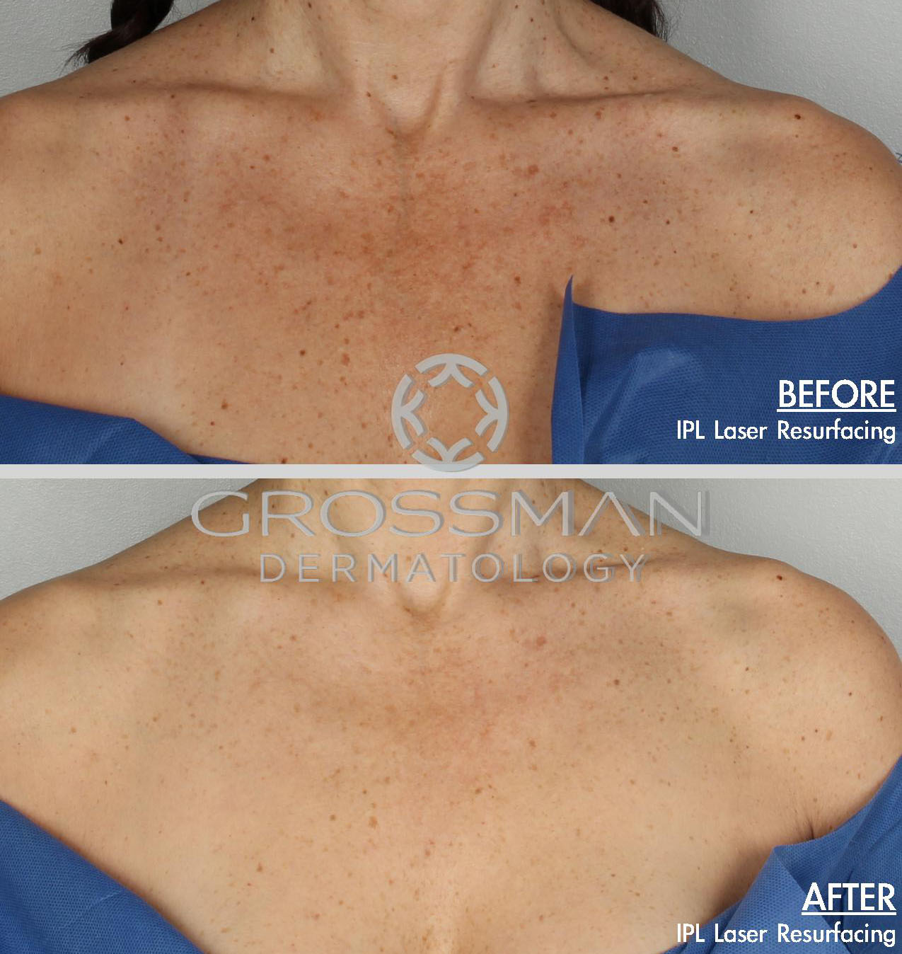 IPL Before & After Photos | Grossman Dermatology