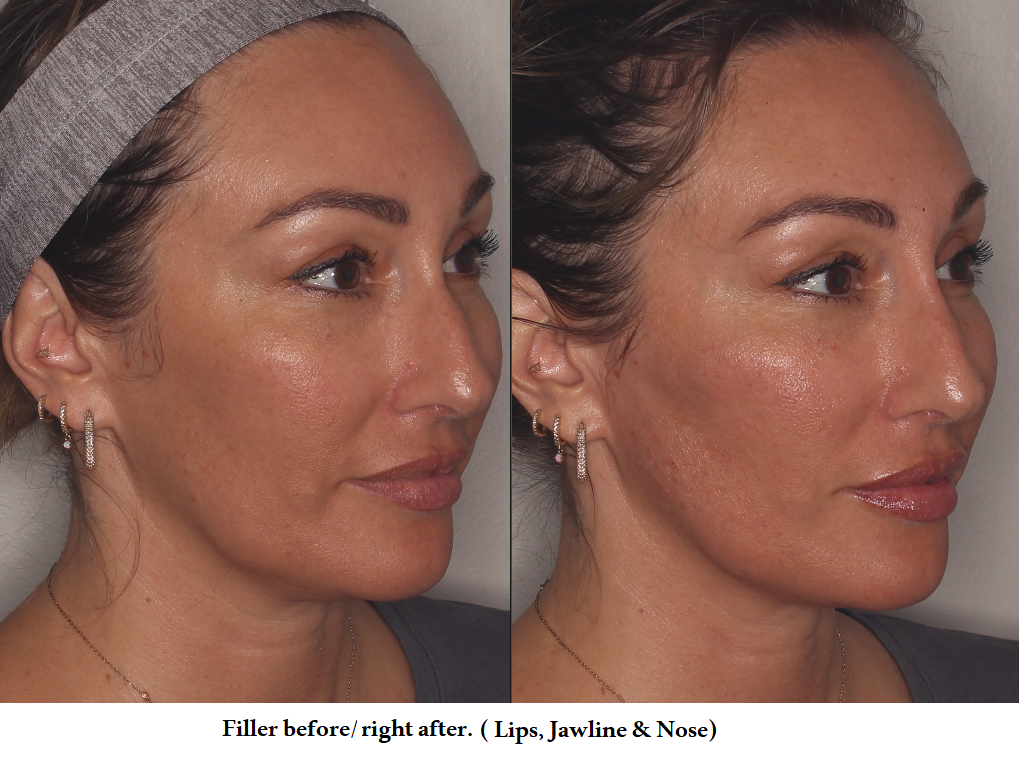 Full Face Before & After Photos | Grossman Dermatology