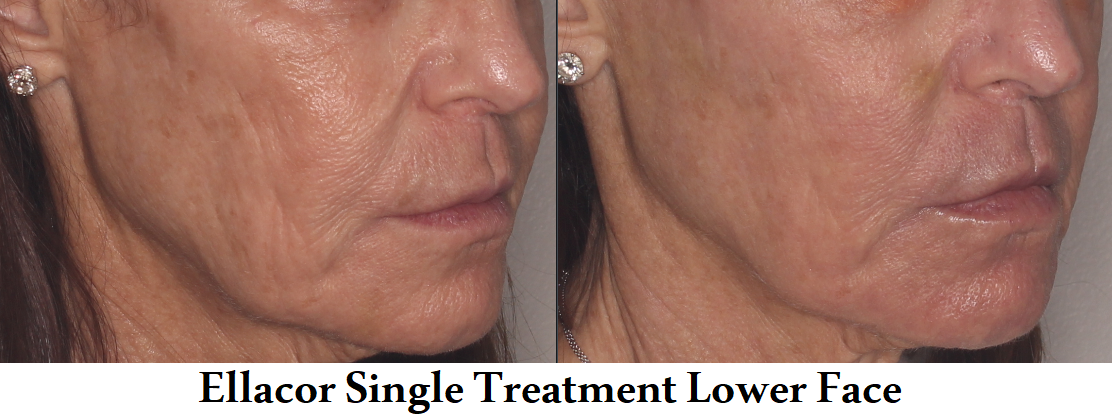 Ellacor Before & After Photos | Grossman Dermatology