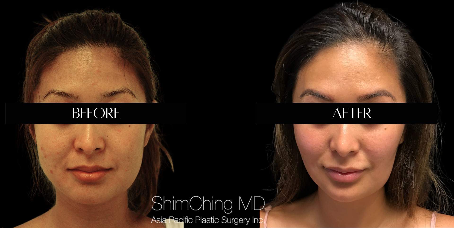 Jawline Reduction Plastic Surgery