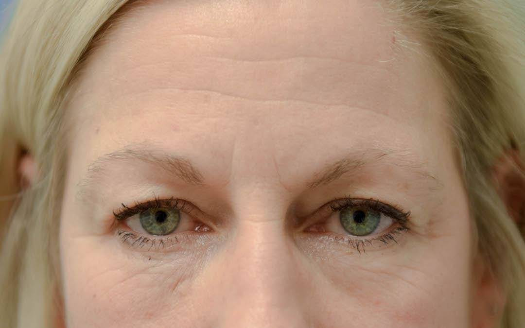 Neuromodulators (Botox, Dysport...) Before & After Photos | Frankel ...