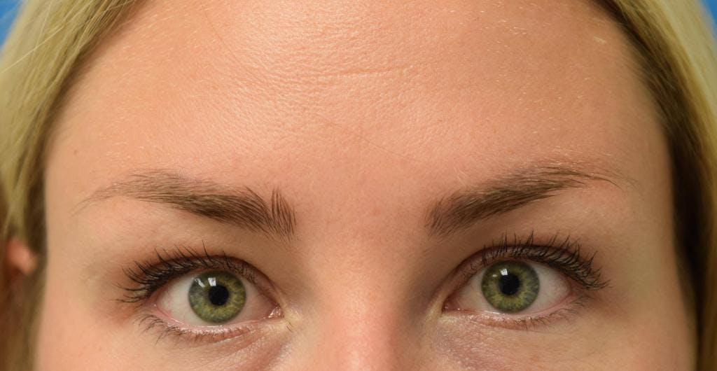 Neuromodulators Botox Dysport Before And After Photos Frankel