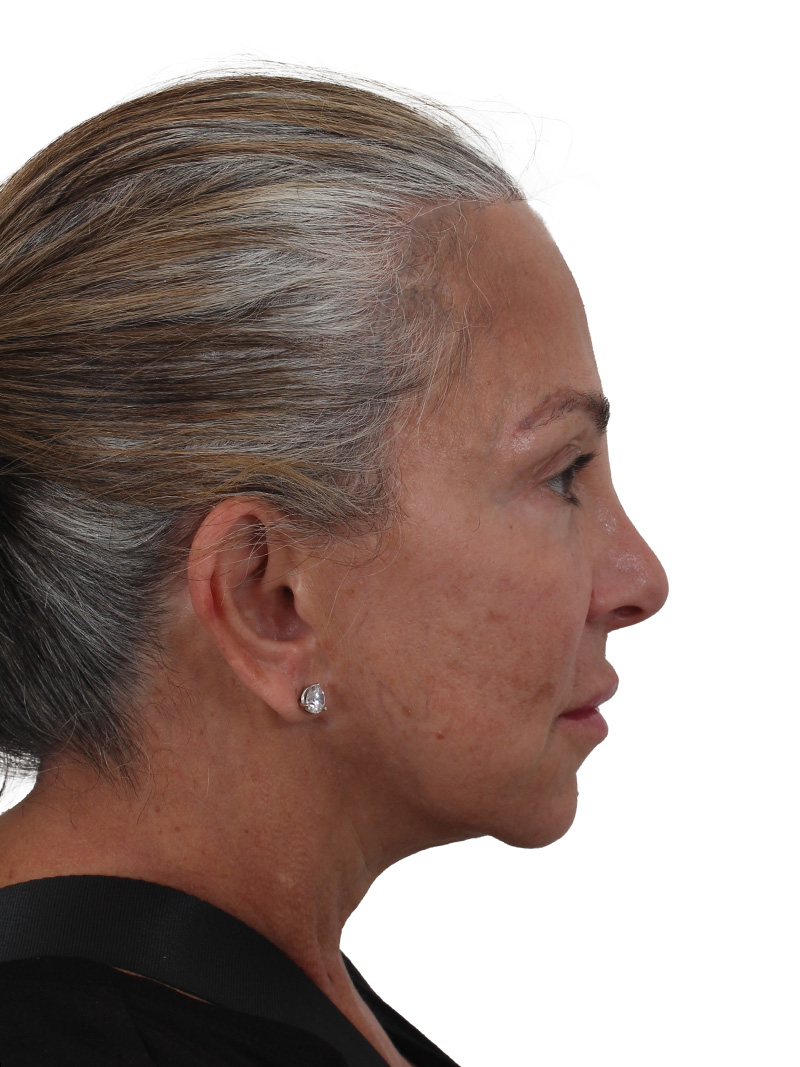 Patient 182634069 | Fat Transfer Before & After Photos | Frankel Facial ...