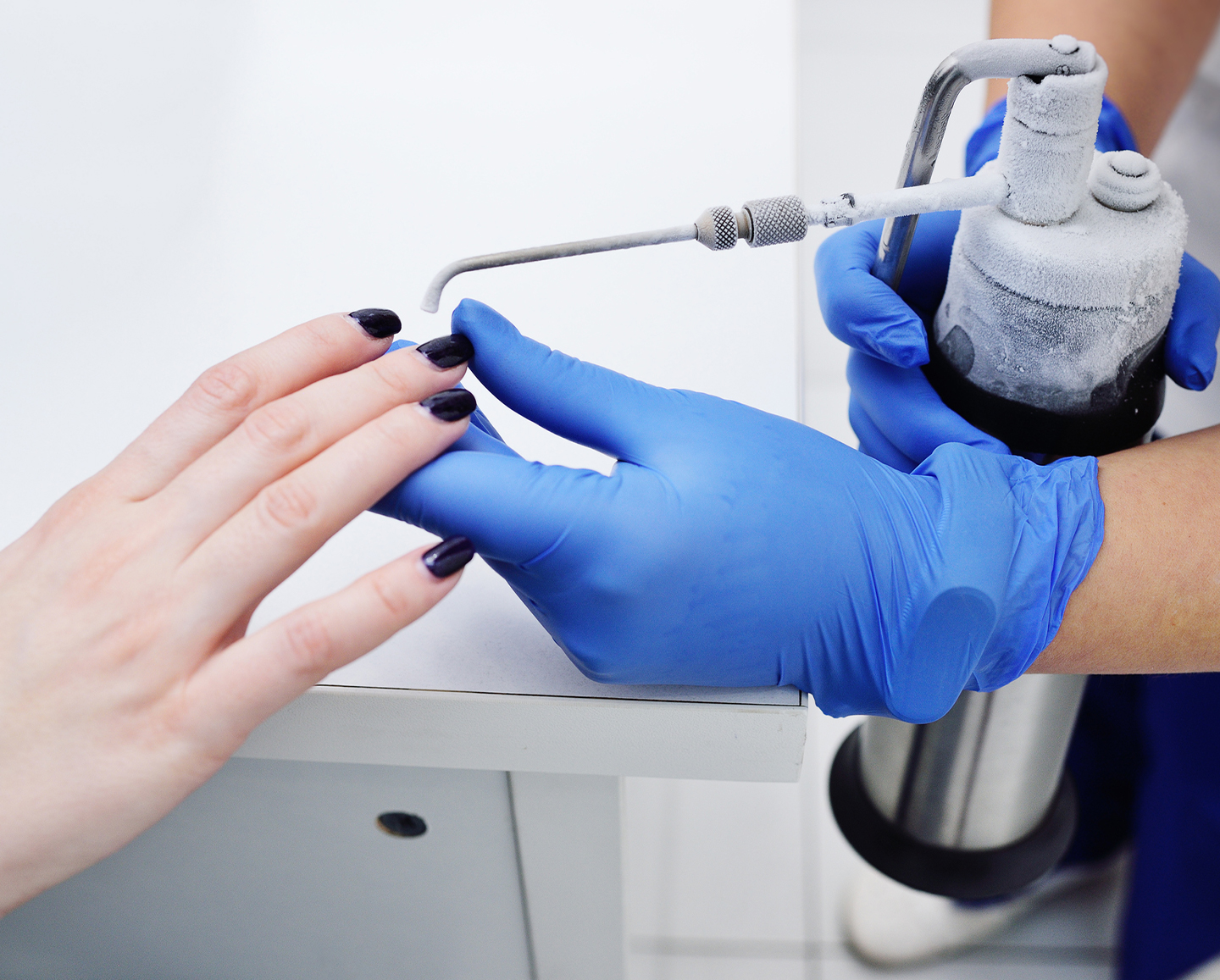 Wart Removal Shrewsbury, MA | Skin Dermatology Worcester