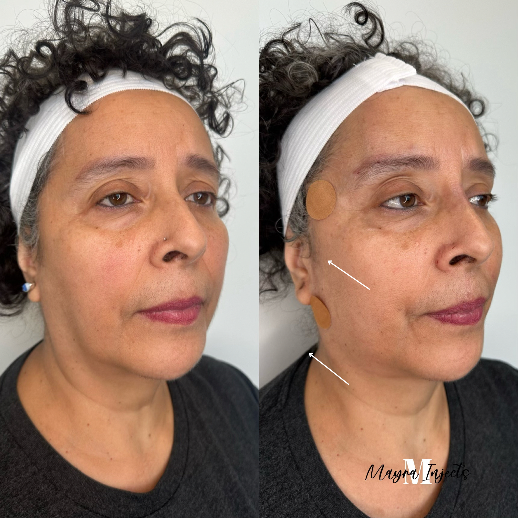 PDO Thread Lift Houston, TX | Chamata Plastic Surgery