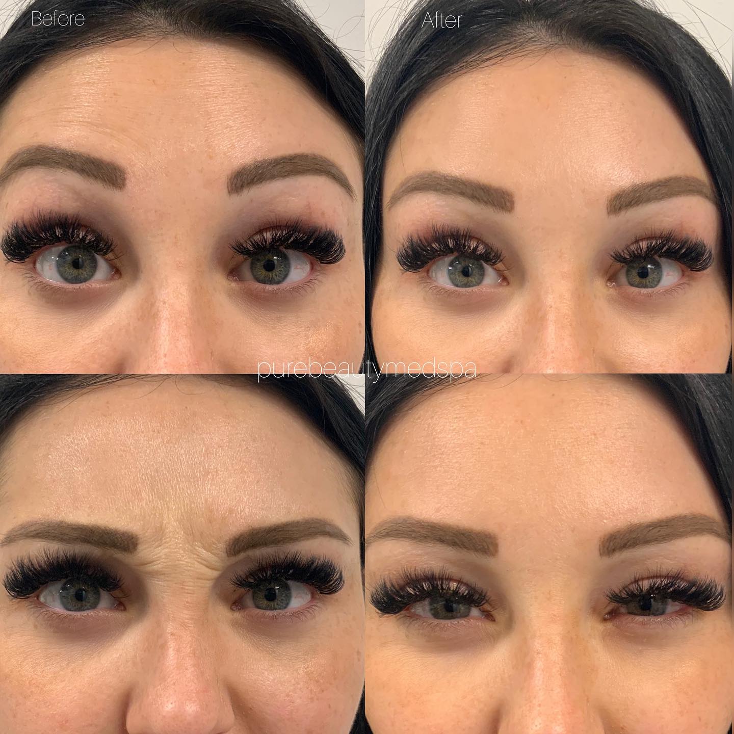 BOTOX Gallery | Pure Beauty Skin Care & Medical Spa