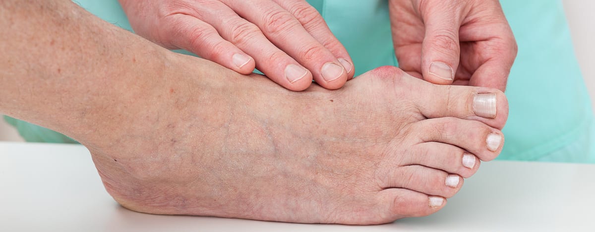 Hammer Toe: Symptoms and Treatments | Orange County Foot and Ankle Doctor