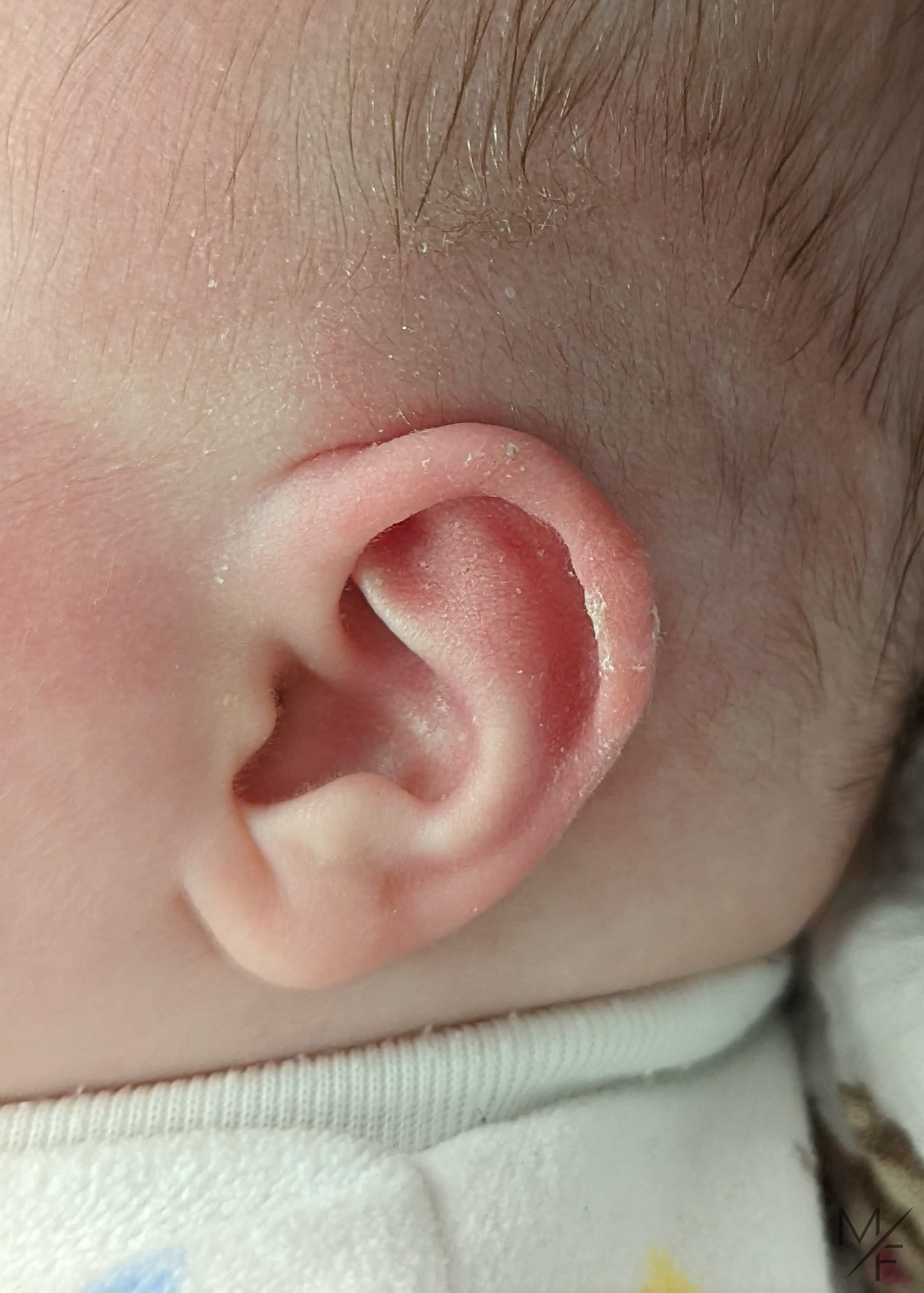 Ear Molding Westport, Connecticut | Dr. Mark Fisher