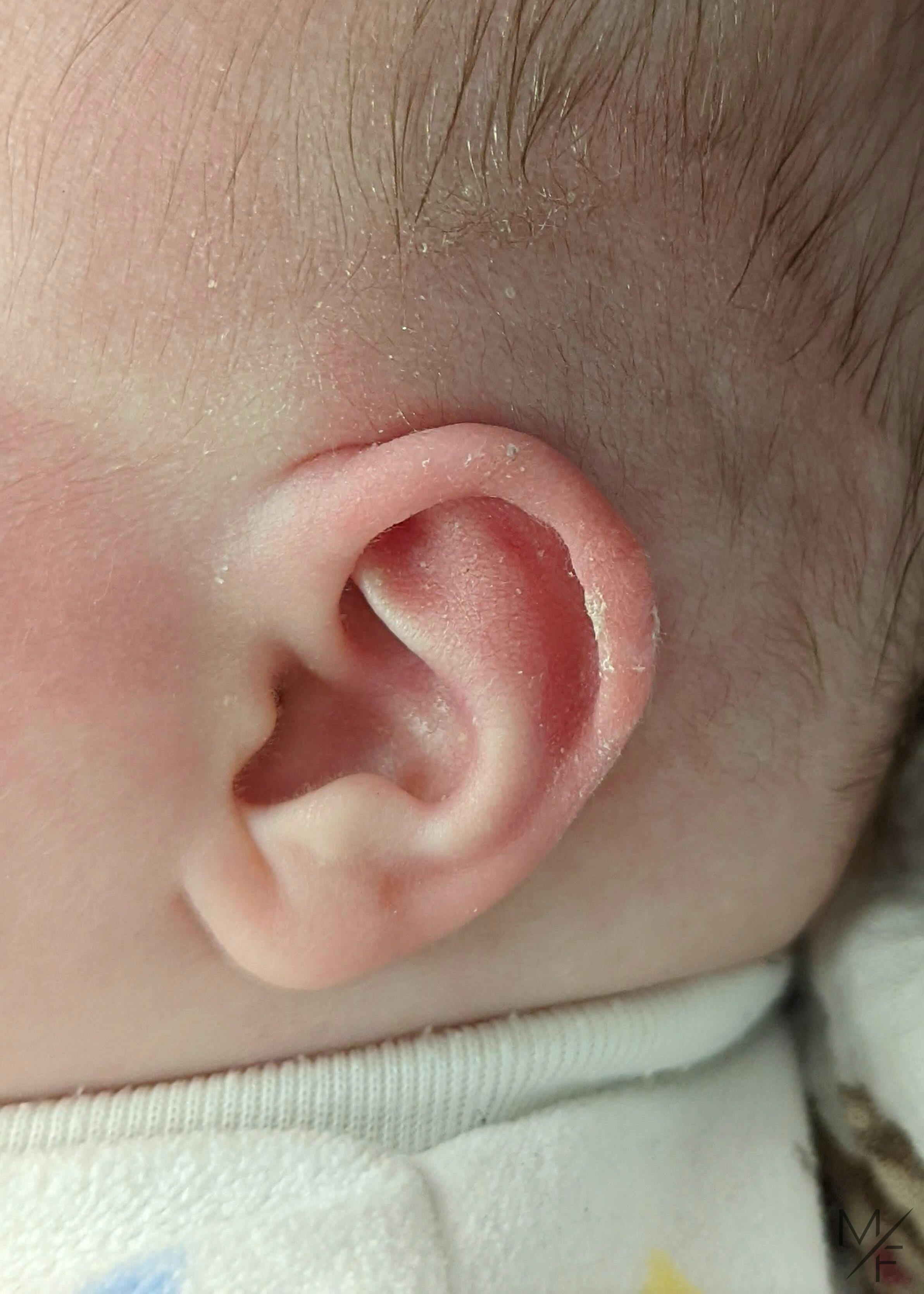 Ear Molding Westport | Dr. Mark Fisher