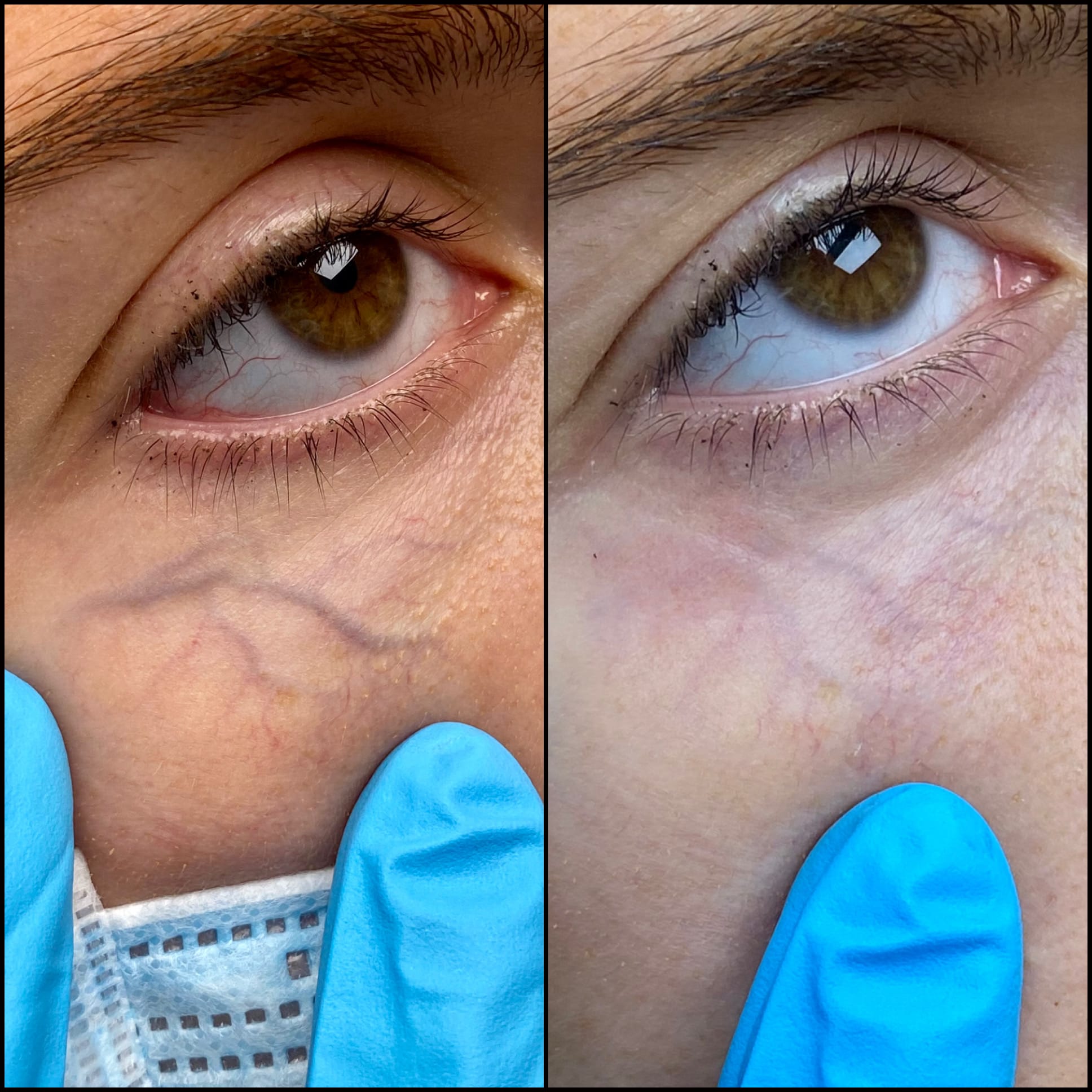 Under Eye Vein Treatment Before & After Photos | Flora Levin MD