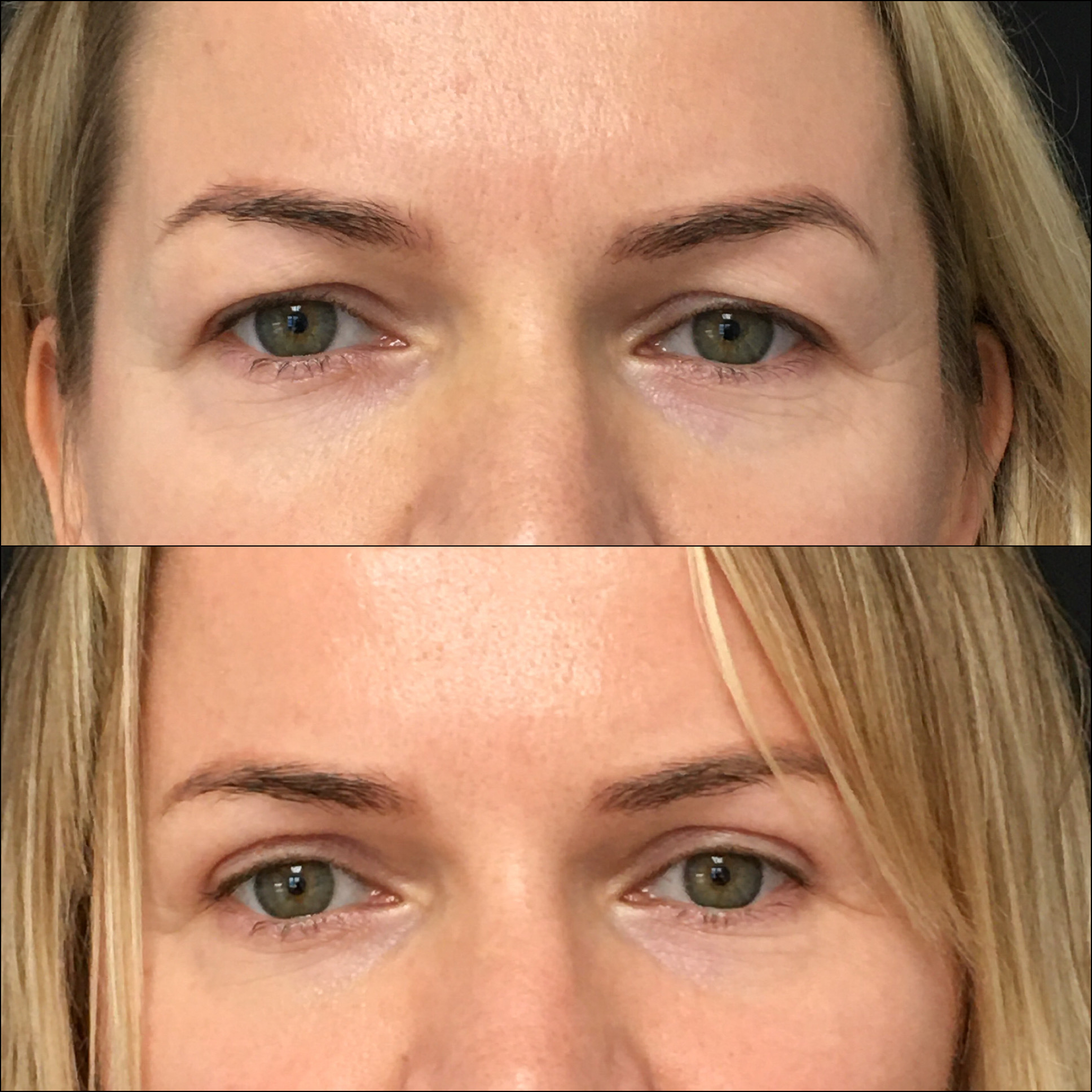 Blepharoplasty Upper Eyelid Before And After