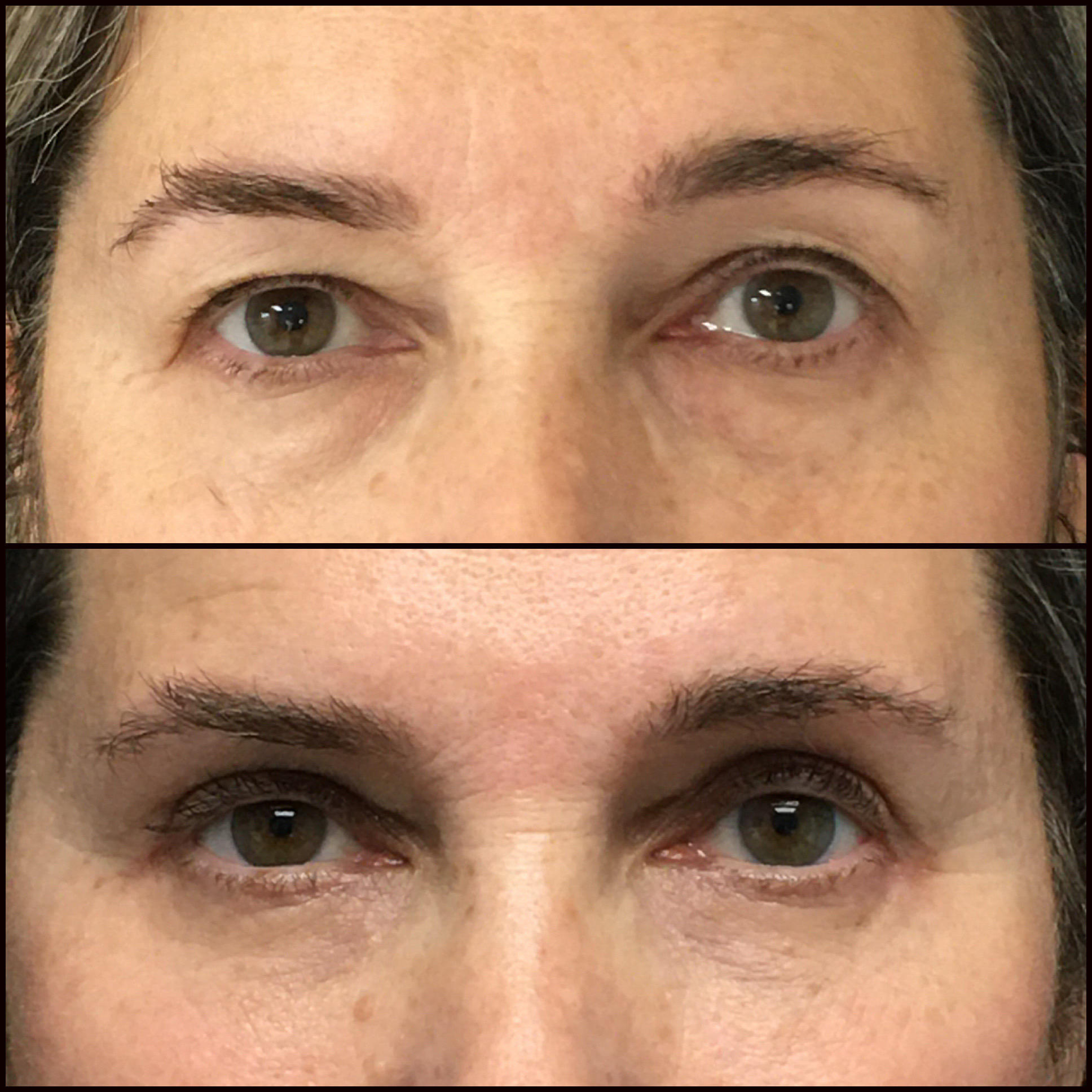 Pictures After Eye Surgery