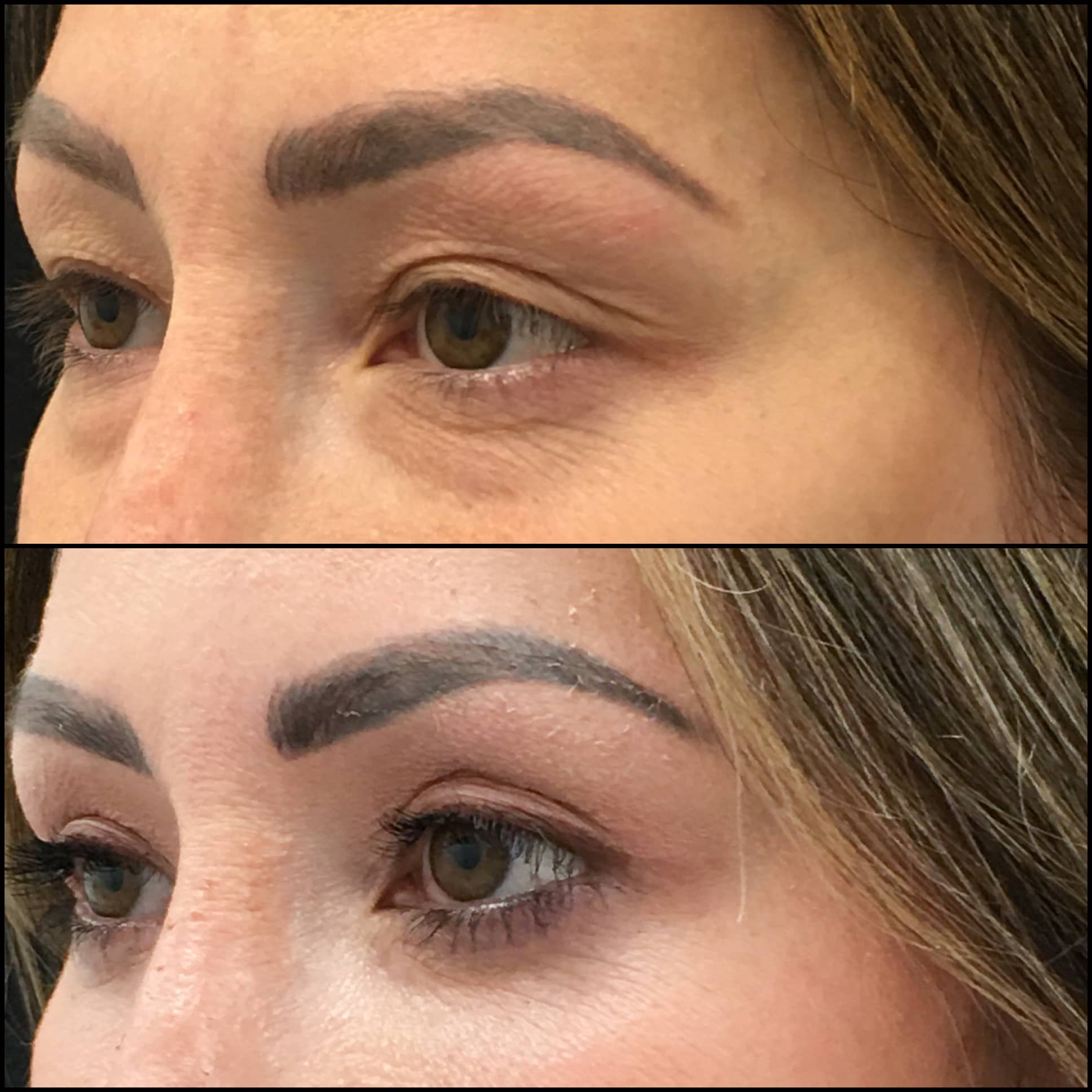Lower Blepharoplasty Before & After Photos | Flora Levin MD