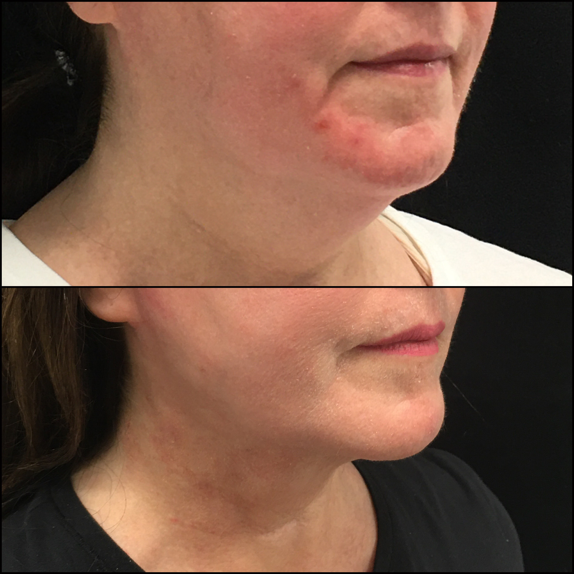 Submental Liposuction Before & After Photos | Flora Levin MD