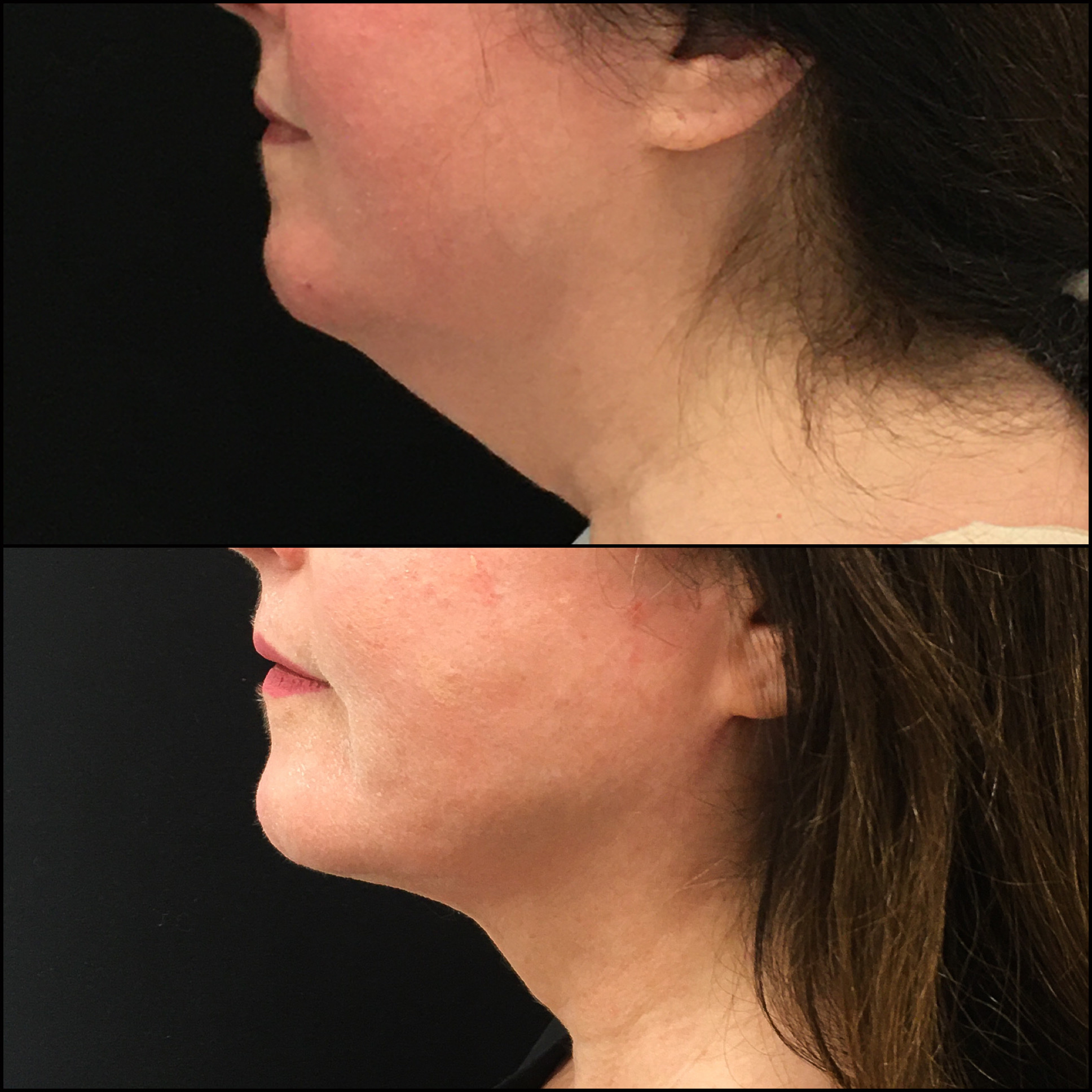 Submental Liposuction Before & After Photos | Flora Levin MD