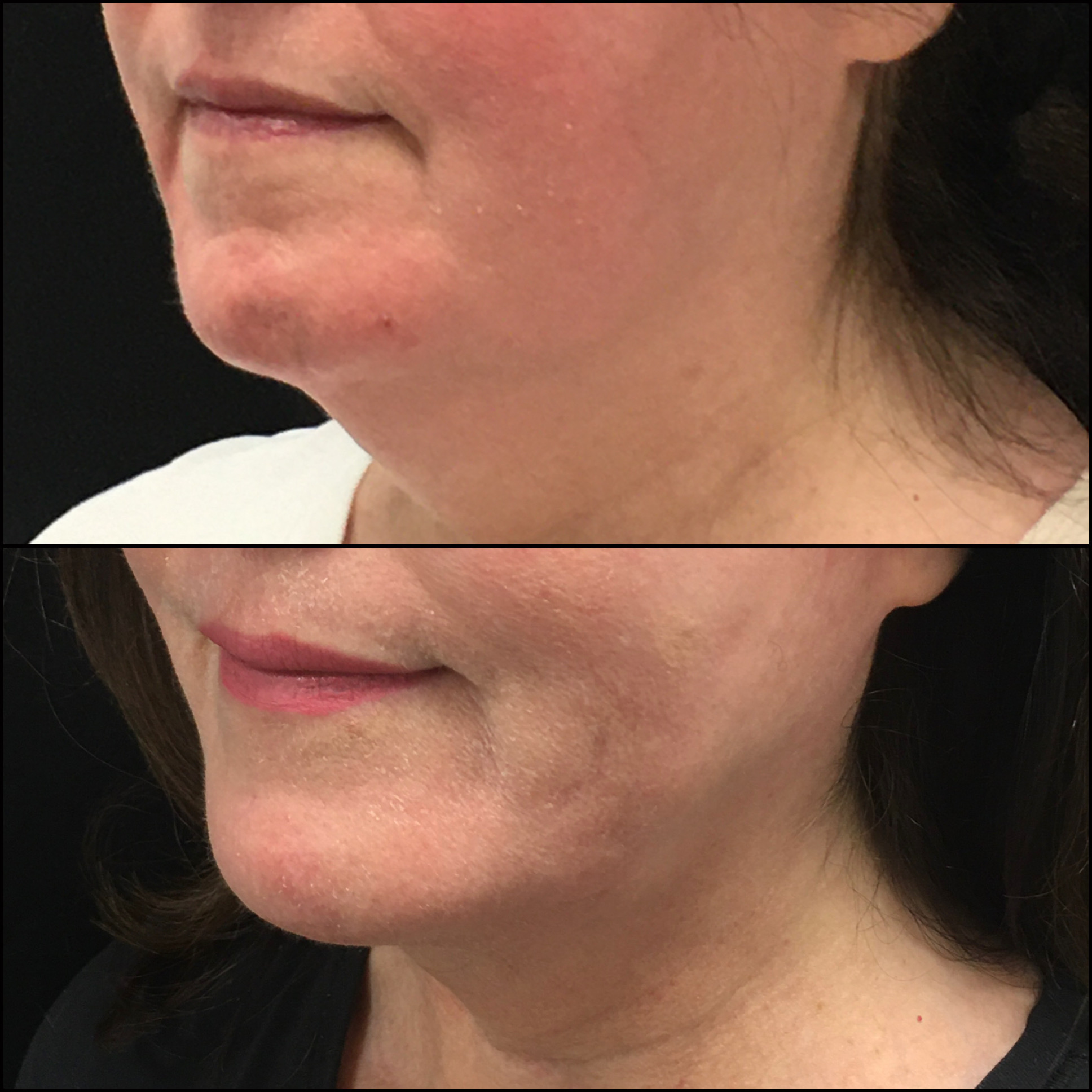Submental Liposuction Before And After Photos Flora Levin Md