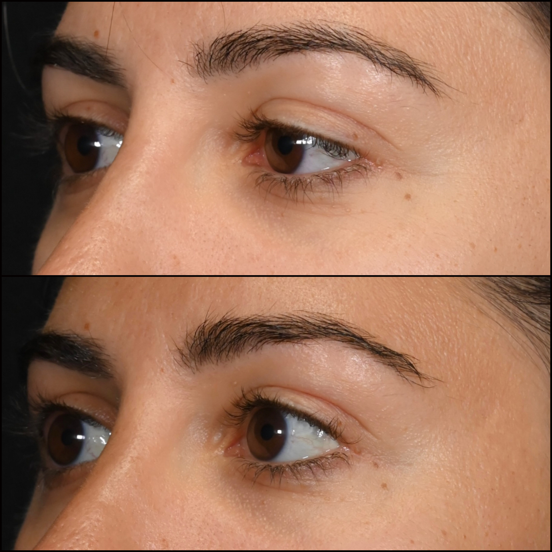 Ptosis Repair Before & After Photos | Flora Levin MD