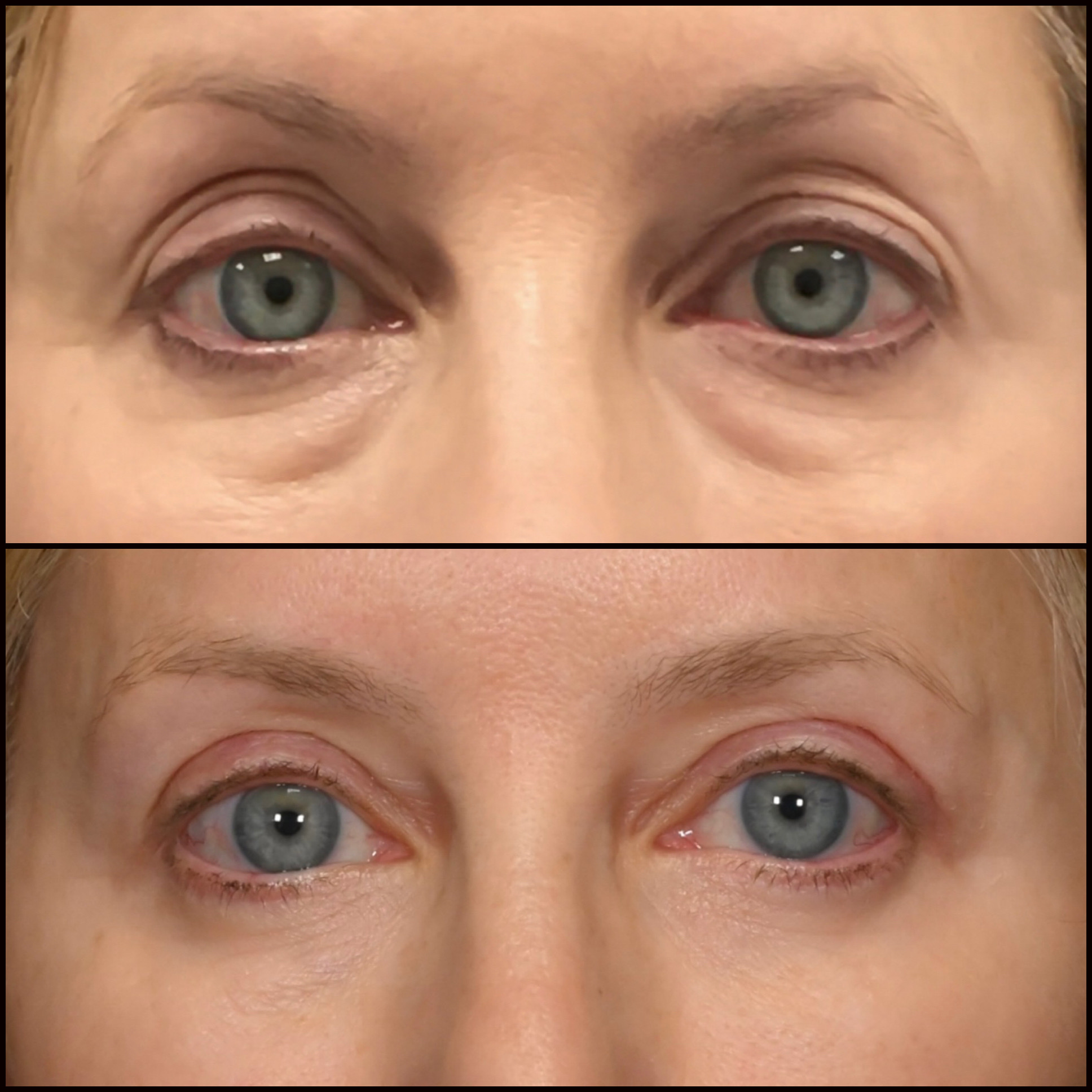 Lower Blepharoplasty Before & After Photos | Flora Levin MD