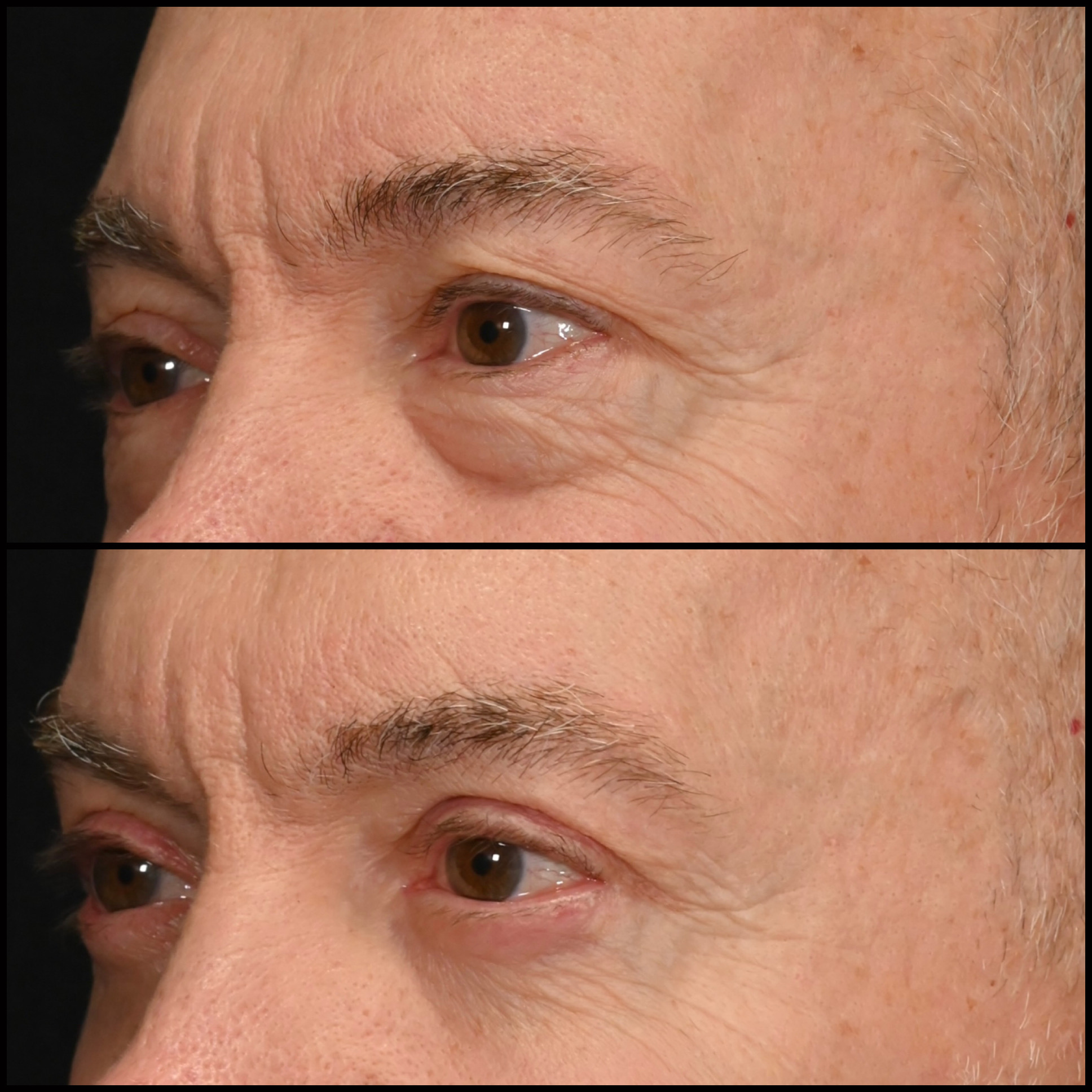 Lower Blepharoplasty Before And After Photos Flora Levin Md