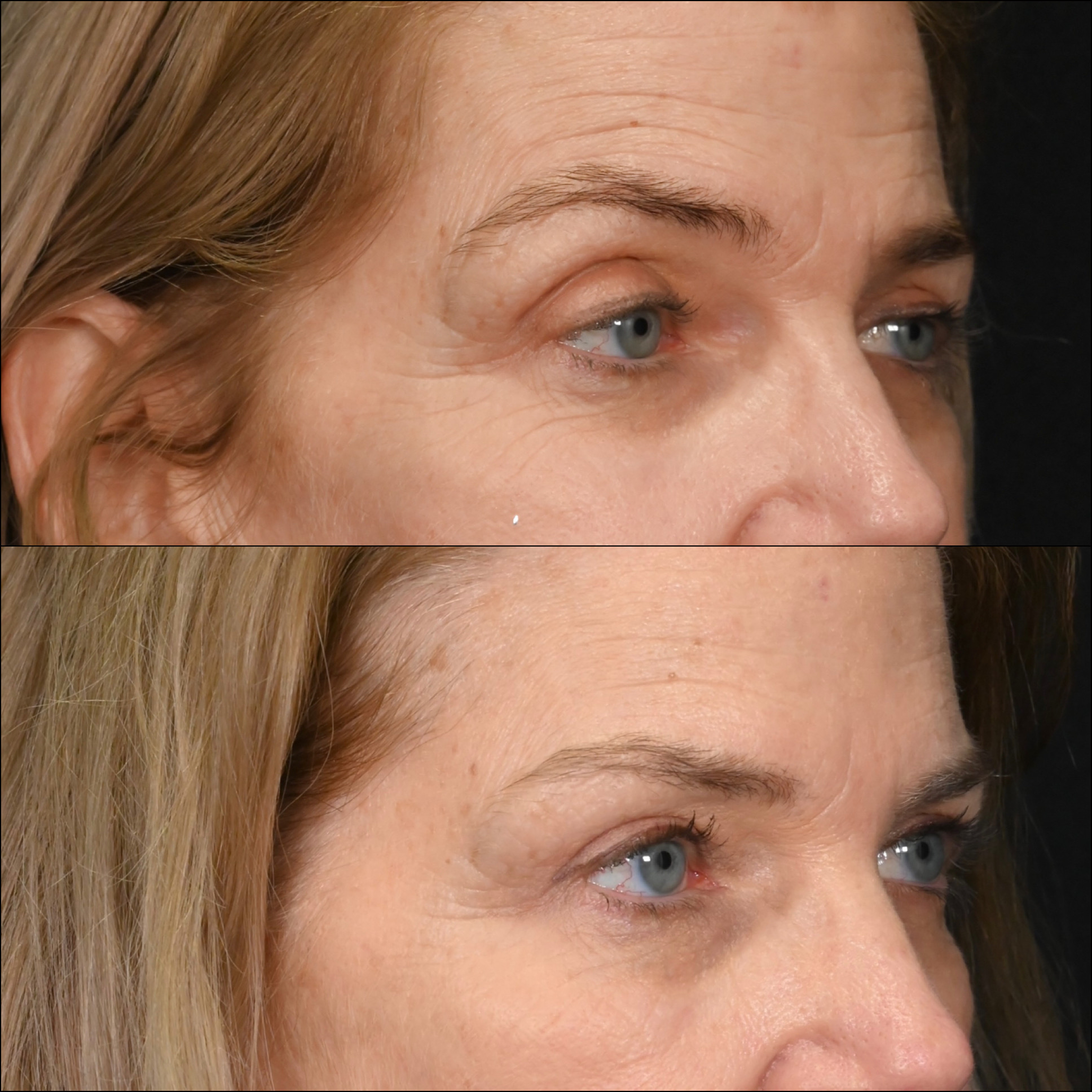 Upper Blepharoplasty Before & After Photos | Flora Levin MD